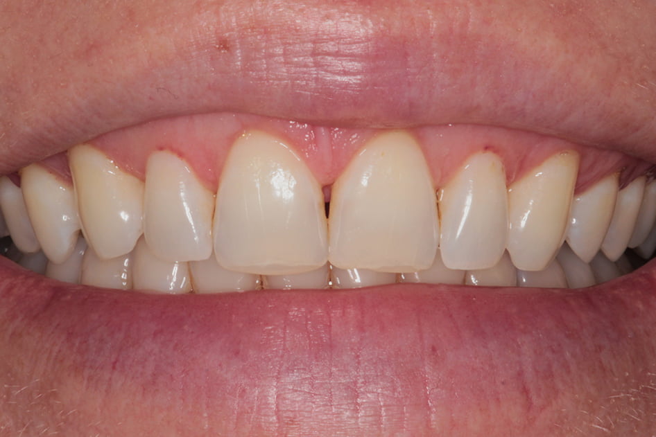 Gummy Smiles Essex - Excess Gums Romford